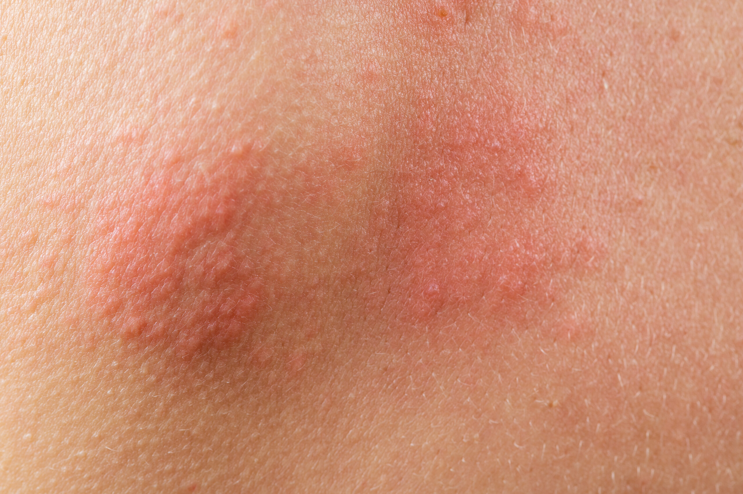 What Difference Will Expert Skin Allergy Testing in Quincy Make ...